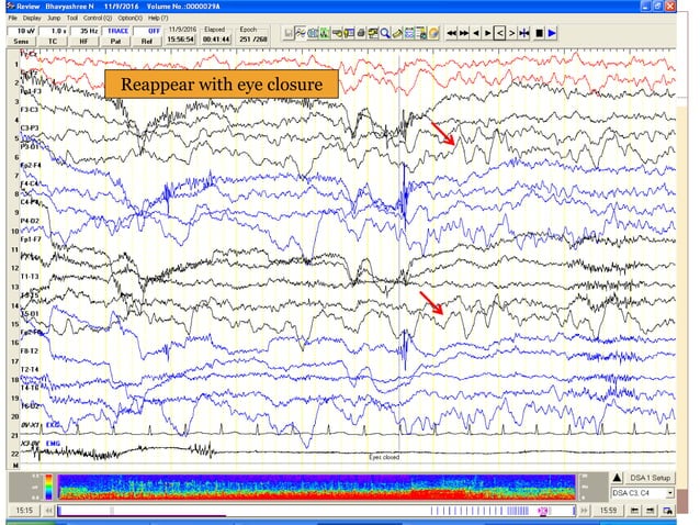 normal eeg