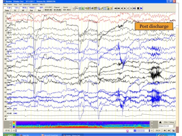 normal eeg