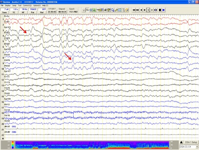 normal eeg