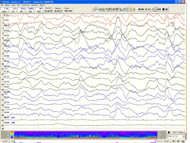 normal eeg