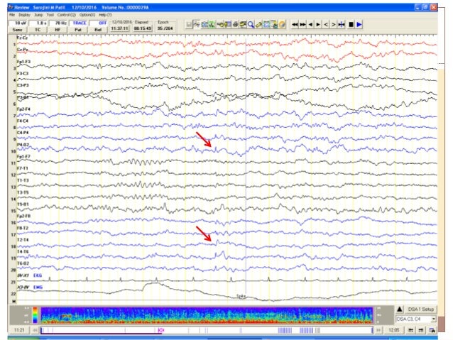 normal eeg