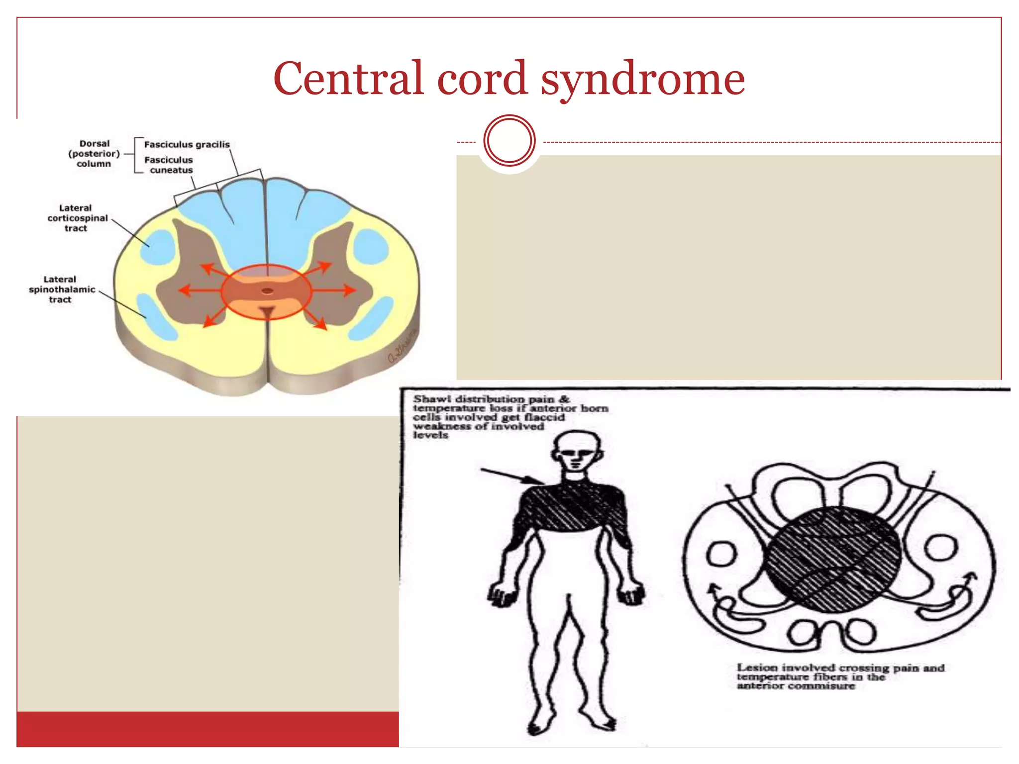 spinal cord anatomy and spinal cord syndromes | PPTX