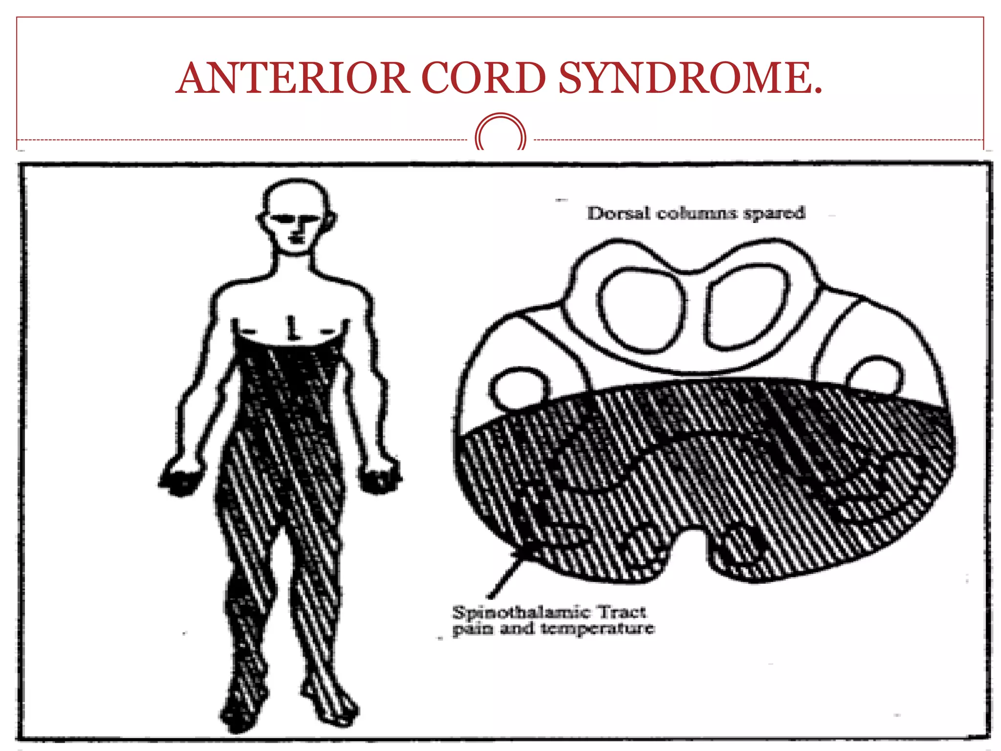 spinal cord anatomy and spinal cord syndromes | PPT