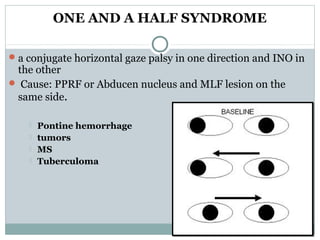 One And A Half Syndrome