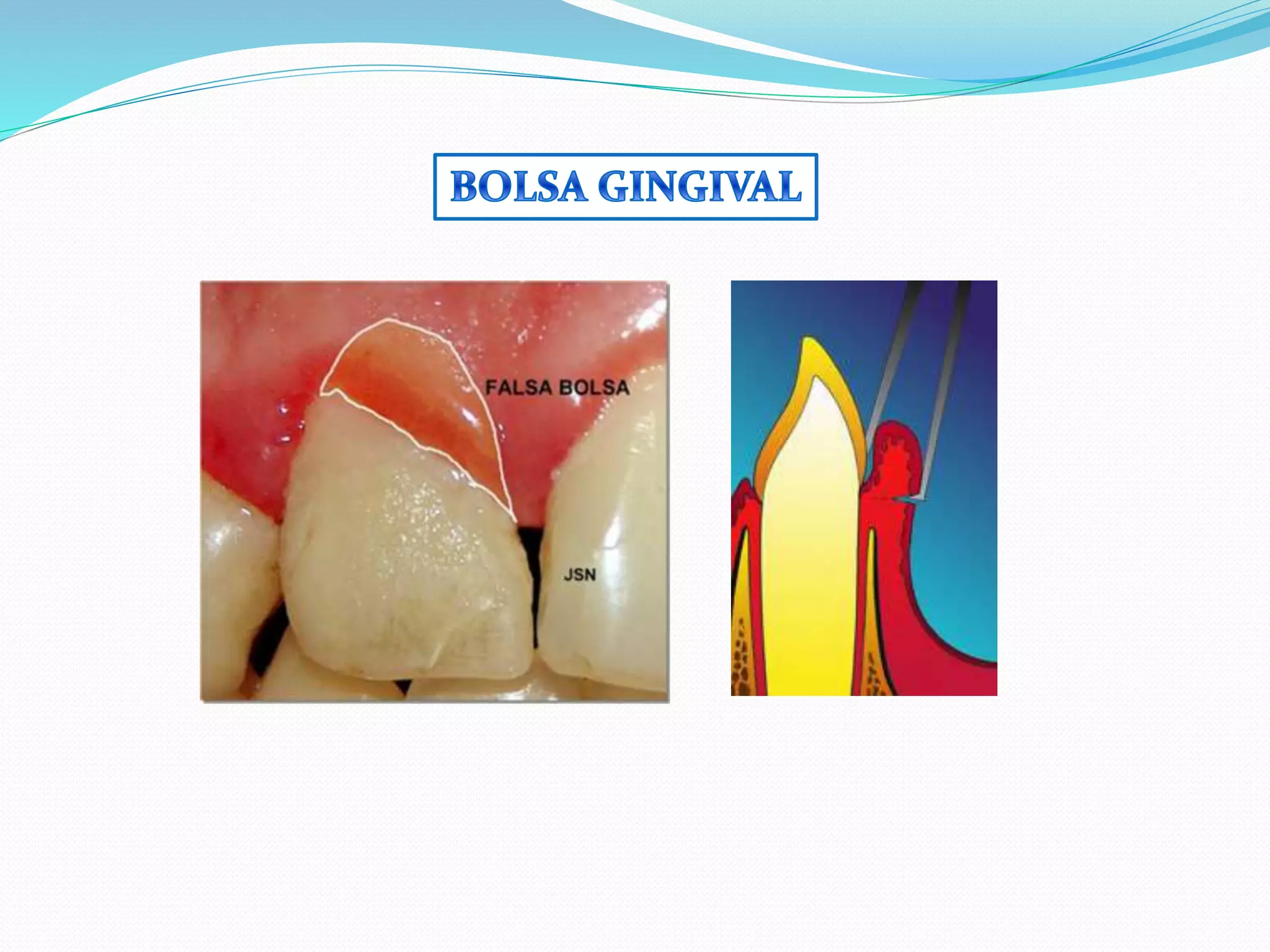Saco periodontal y lesión de furca | PPTX