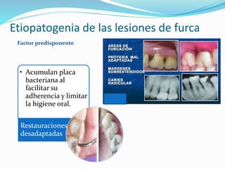 Saco periodontal y lesión de furca | PPT