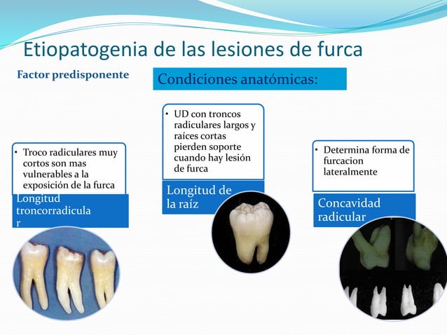 Saco periodontal y lesión de furca