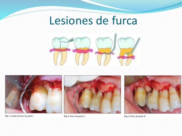 Saco periodontal y lesión de furca