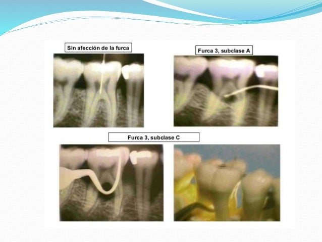 Saco periodontal y lesión de furca