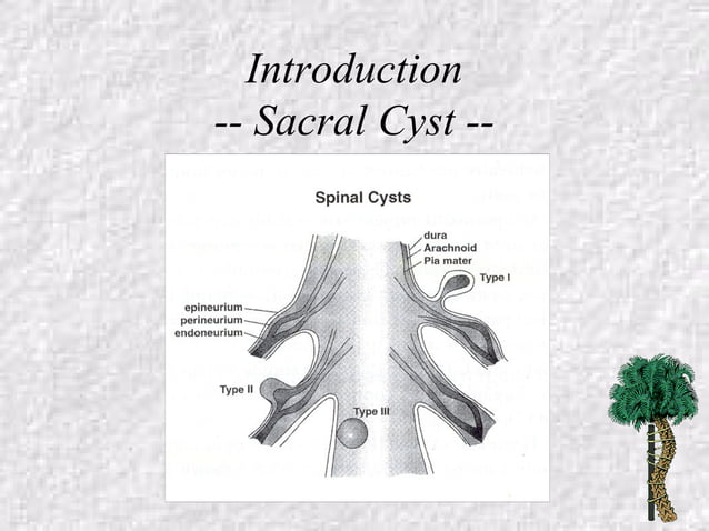 Surgical Treatment of Symptomatic Sacral Cysts | PPT
