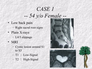 Surgical Treatment of Symptomatic Sacral Cysts | PPT