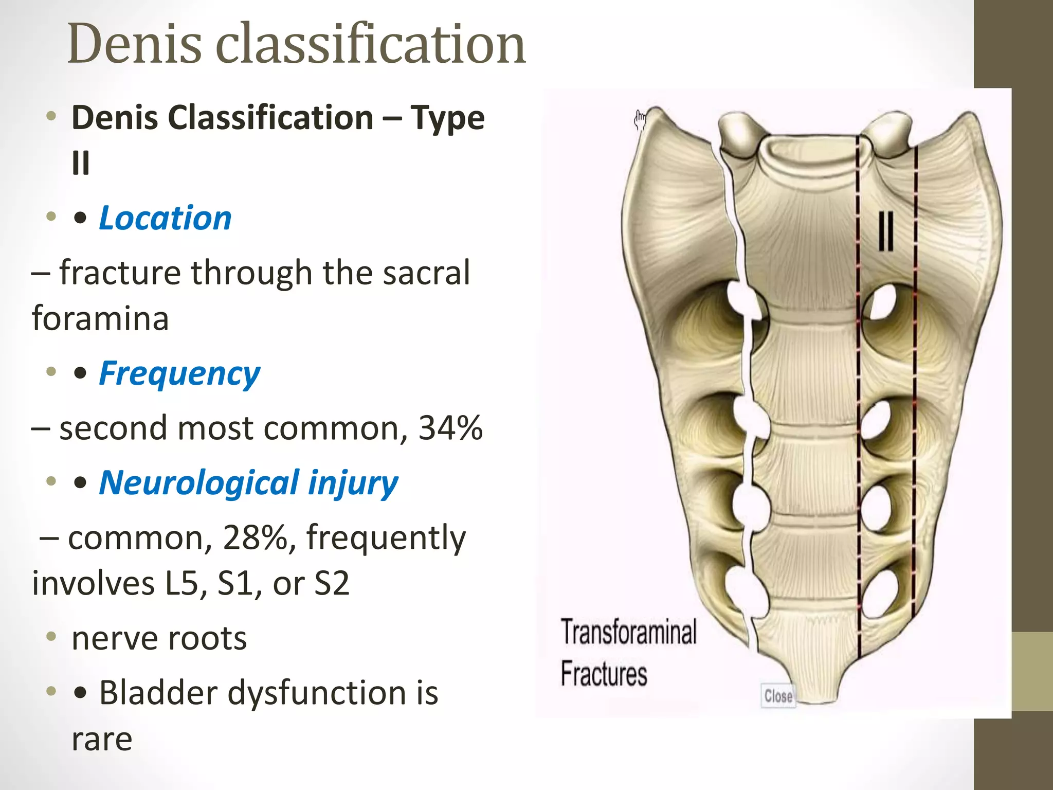 Sacral fracture | PPTX