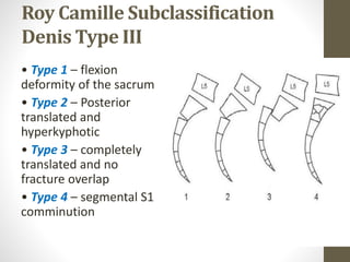Sacral fracture | PPTX