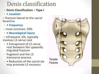 Sacral fracture | PPTX