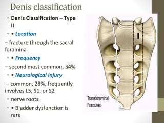 Sacral fracture | PPTX