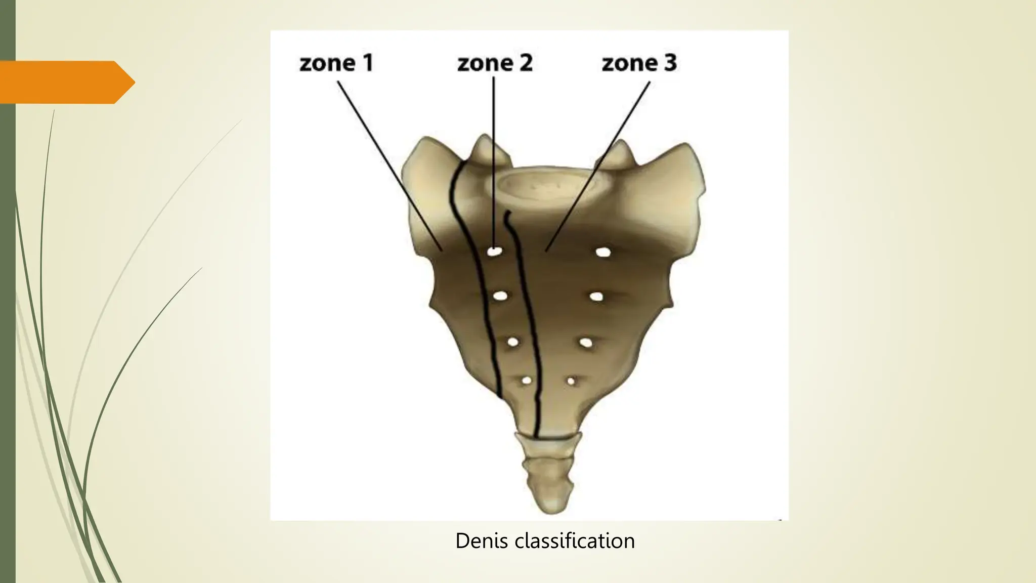 SACRAL FRACTURE or SACRAL TRAUMA POWERPOINT | PPTX