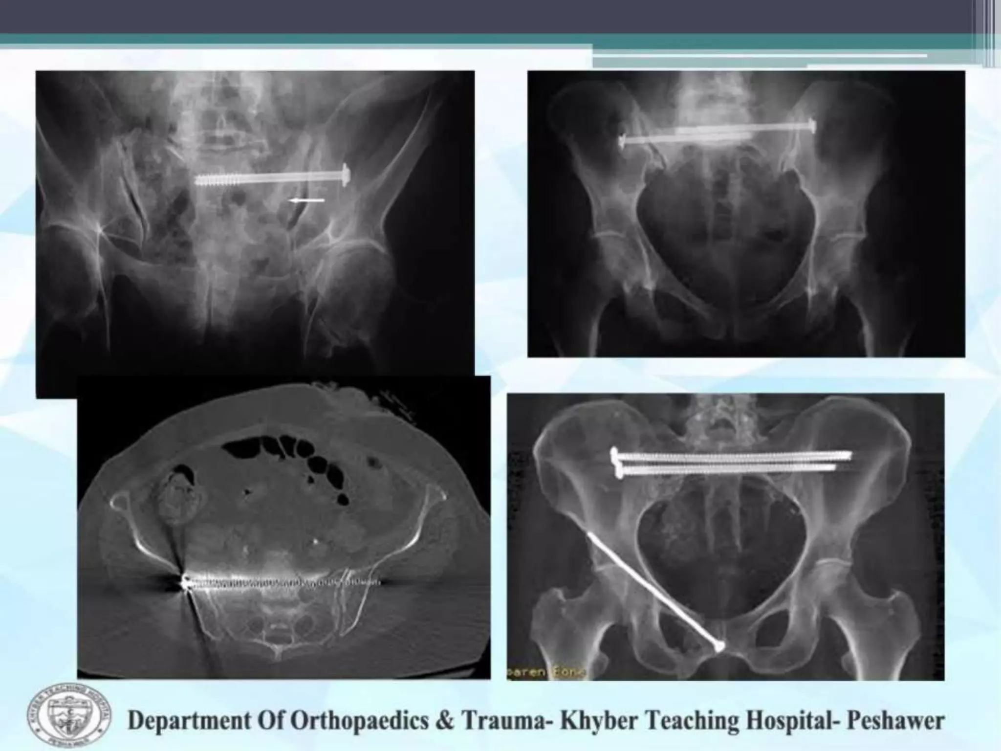 Sacral fractures | PPTX