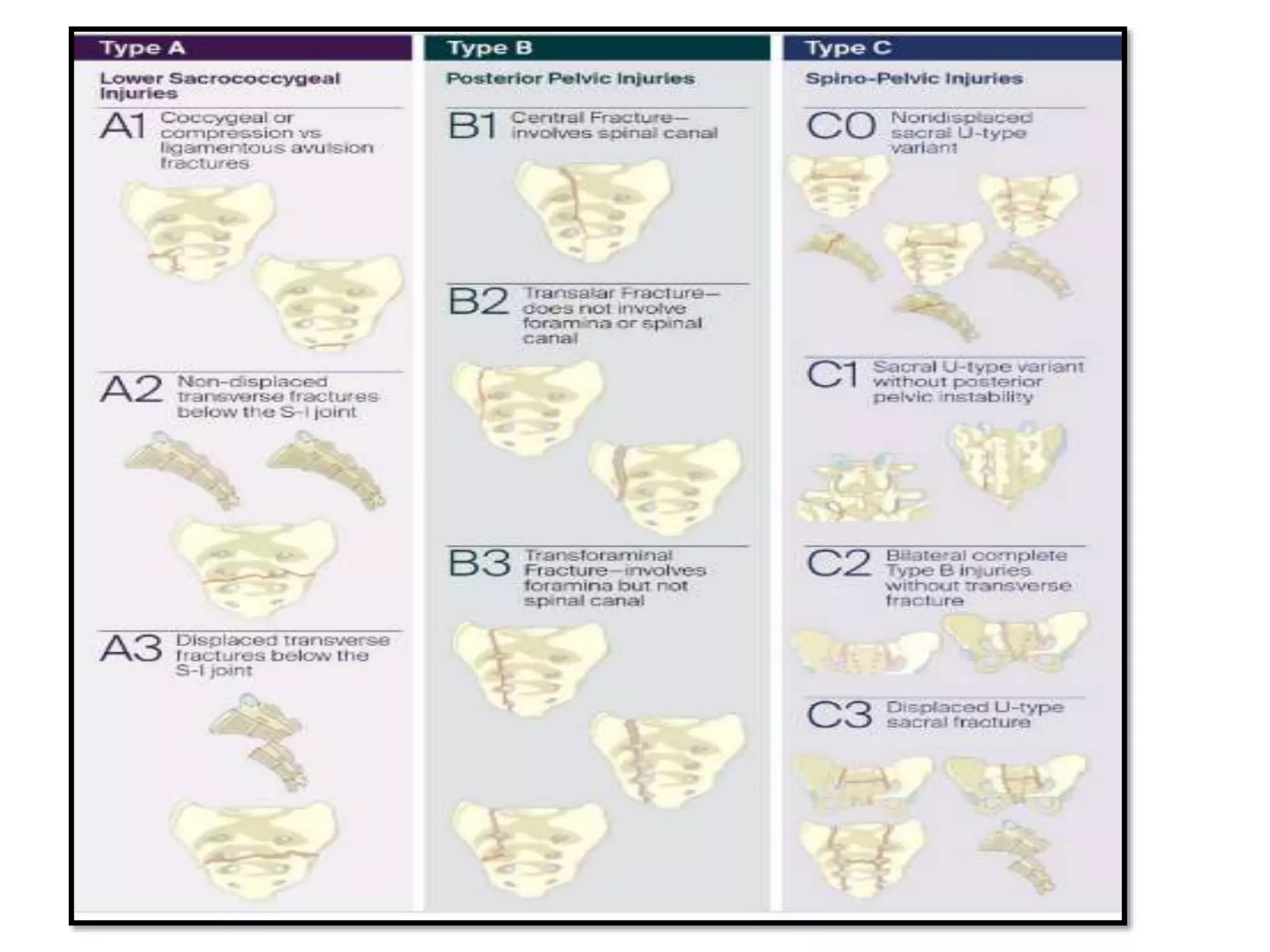 Sacral fractures.pptx