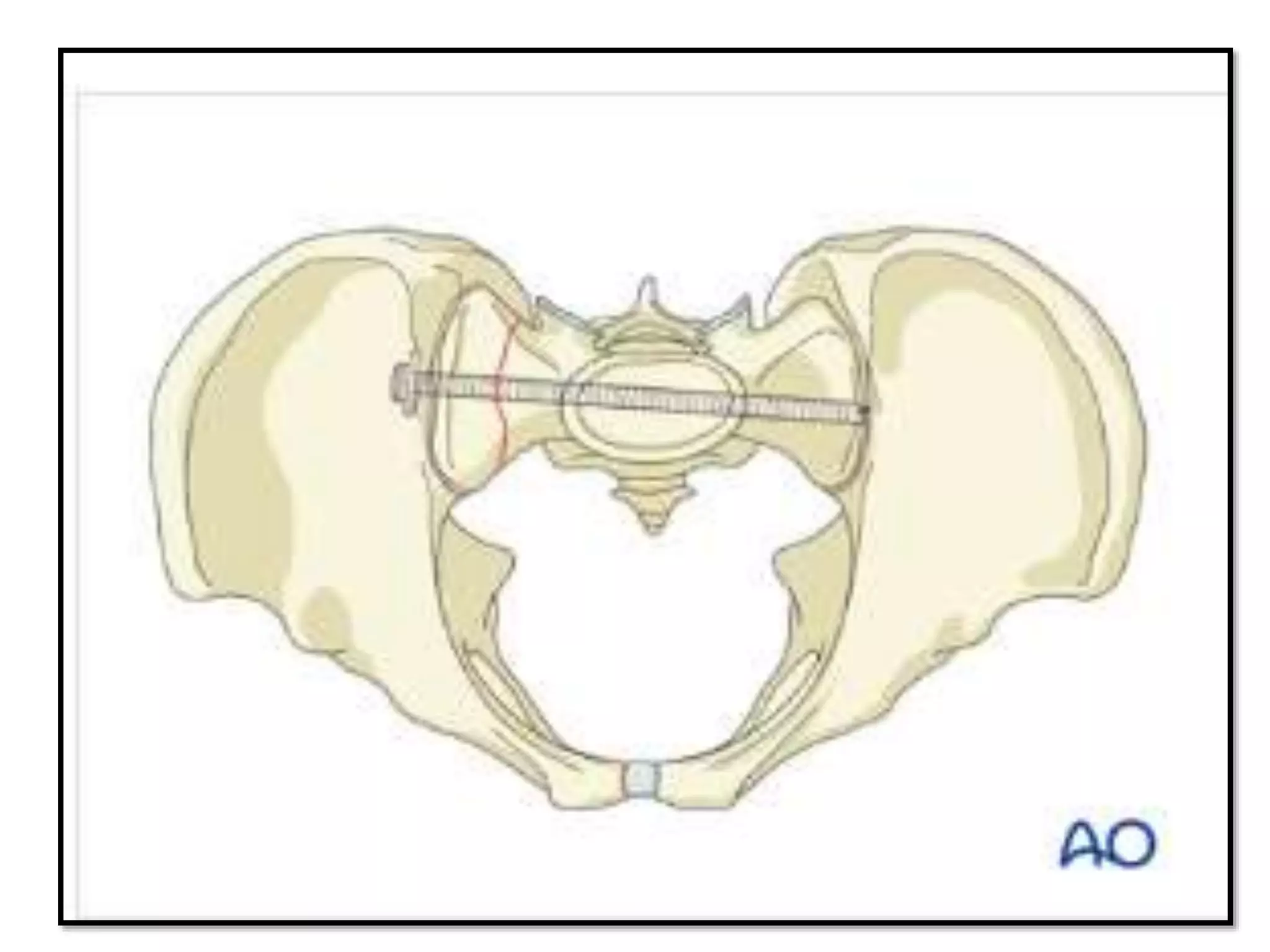 Sacral fractures.pptx