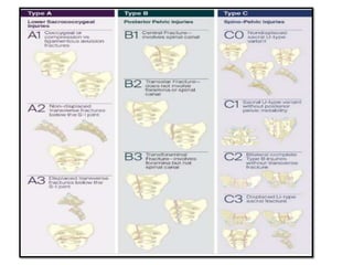 Sacral fractures.pptx