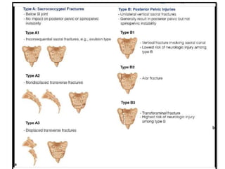 Sacral fractures.pptx