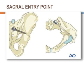 Sacral fractures.pptx