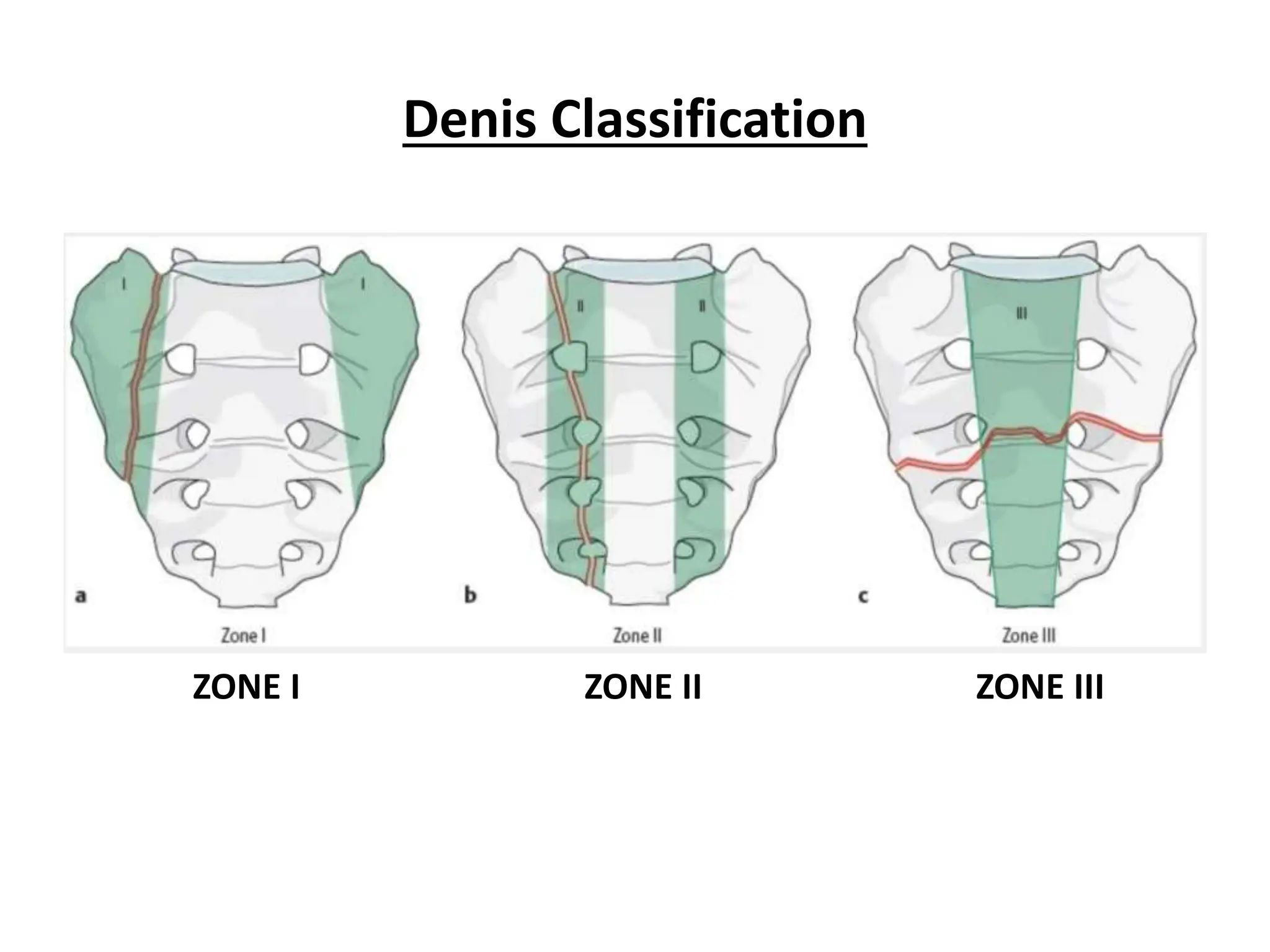 SACRAL FRACTURES.pptx