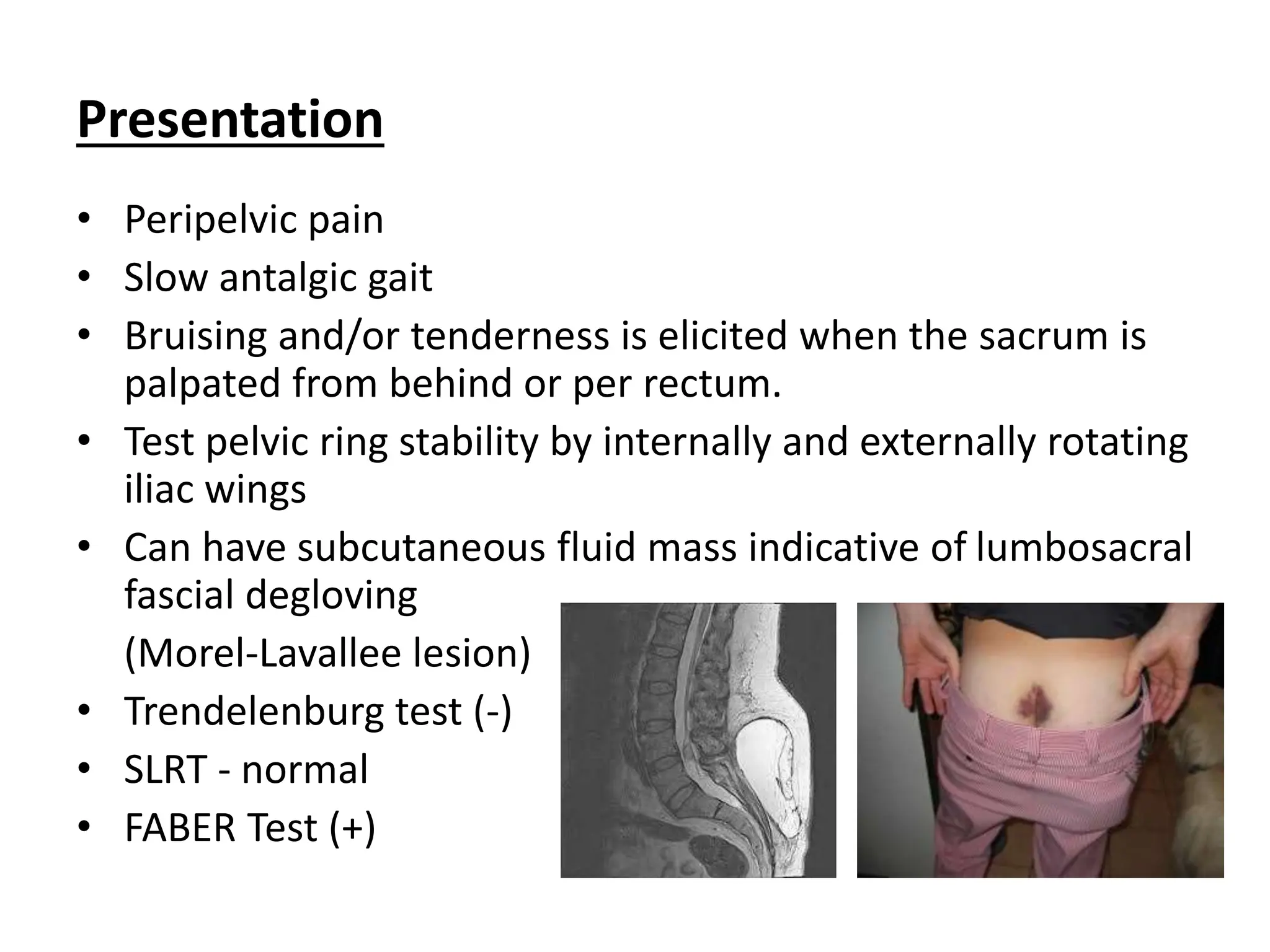 SACRAL FRACTURES.pptx