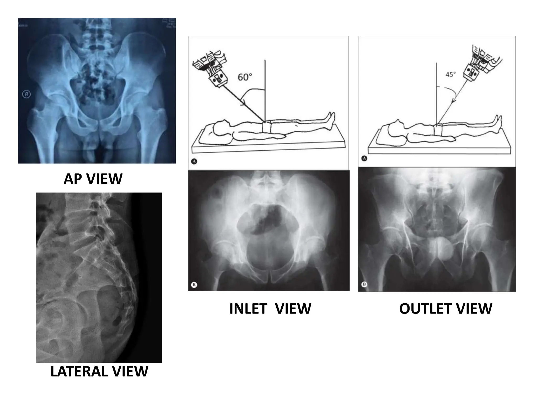 SACRAL FRACTURES.pptx