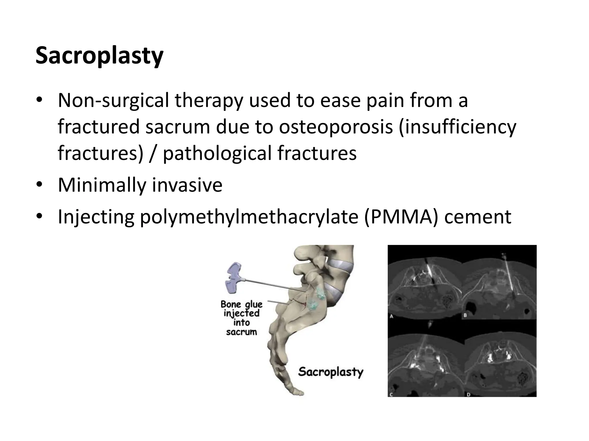 SACRAL FRACTURES.pptx
