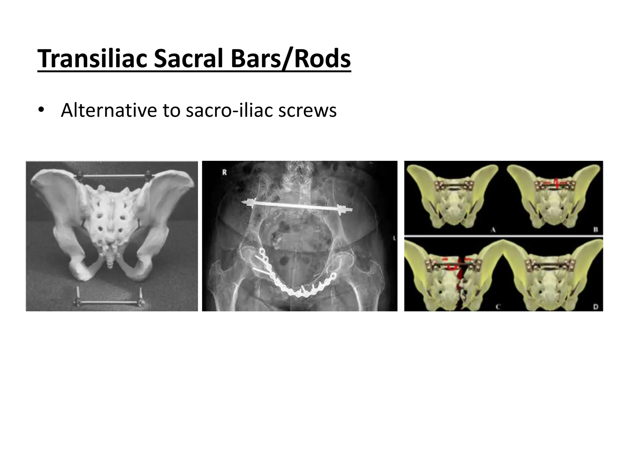 SACRAL FRACTURES.pptx