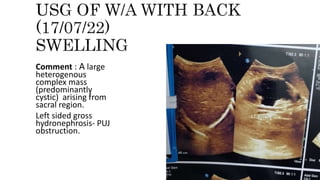 Sacrococcygeal Teratoma.pptx