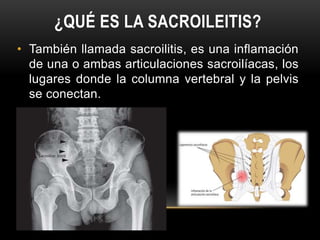 Radiografía De La Articulación Sacroilíaca Normal