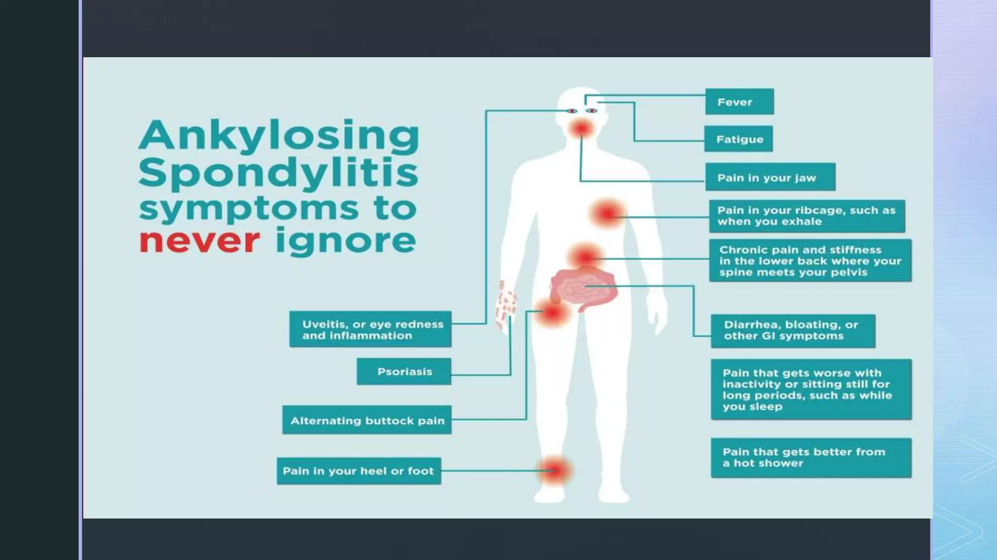 Sacroiliac joint dysfunction | PPTX