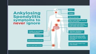 Sacroiliac joint dysfunction | PPTX