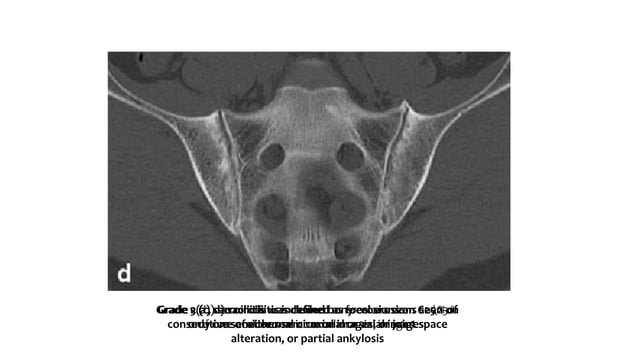 Sacroiliitis | PPTX | Digestive Disorders | Diseases and Conditions