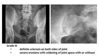 Sacroiliitis | PPTX