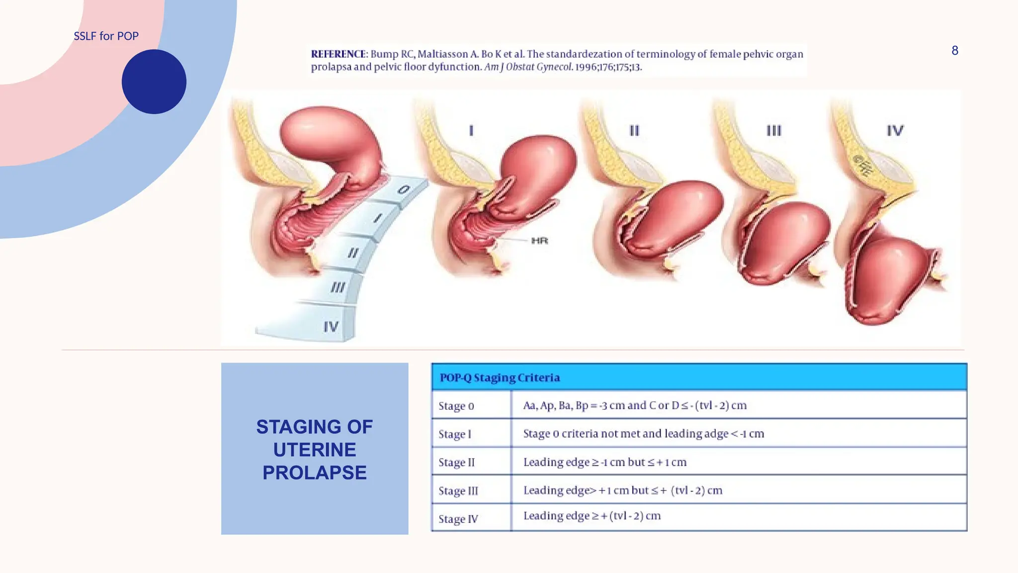 Sacrospinous Ligament Fixation for Pelvic Organ Prolapse - Latest ...