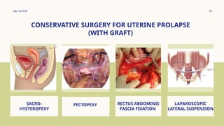Sacrospinous Ligament Fixation for Pelvic Organ Prolapse - Latest ...