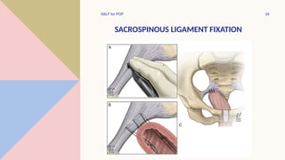 Sacrospinous Ligament Fixation for Pelvic Organ Prolapse - Latest ...