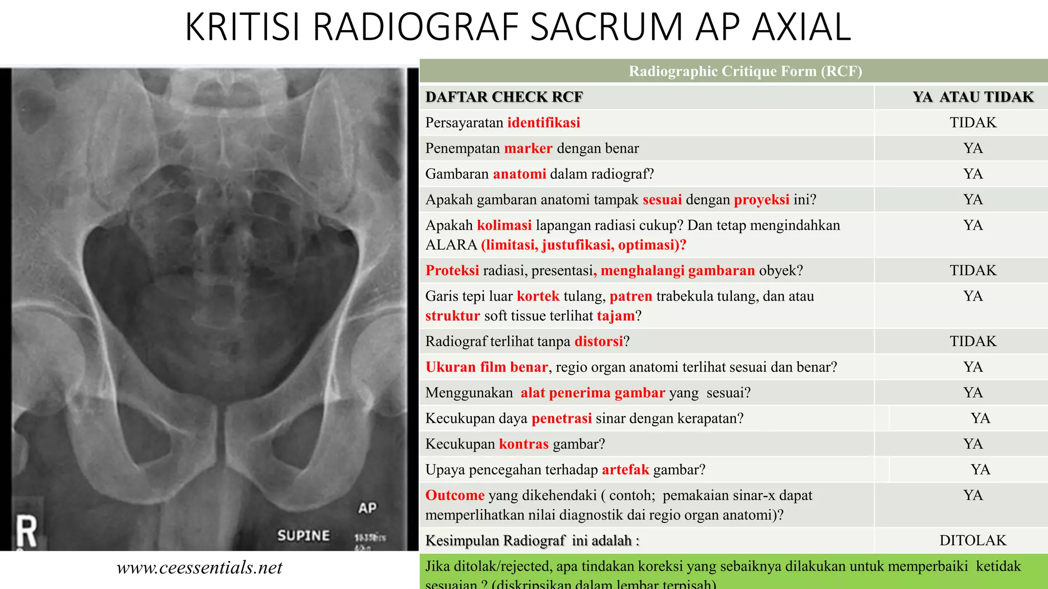 ppt kritisi dan evaluasi radiograf Sacrum dan coccyx | PPTX