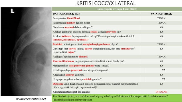 ppt kritisi dan evaluasi radiograf Sacrum dan coccyx | PPTX