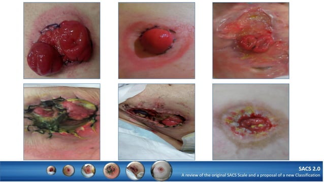 Sacs 2.0 a review of the original sacs scale WUWHS Florence 29.09.2016