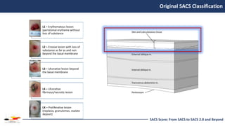 Sacs score from sacs to sacs 2.0 and beyond oral presentation_mario ...