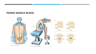 Saddle block dedi.pptxhgchgfhgvhjhgjhgjyhgjyhgu | PPT