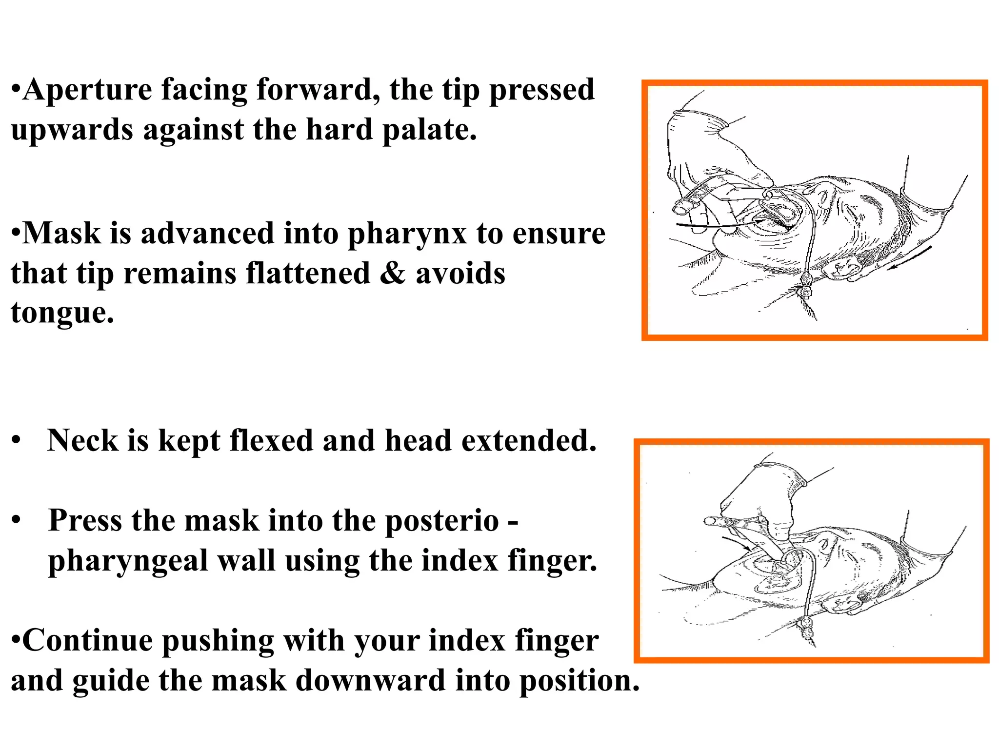 supraglottic airway devices | PPTX
