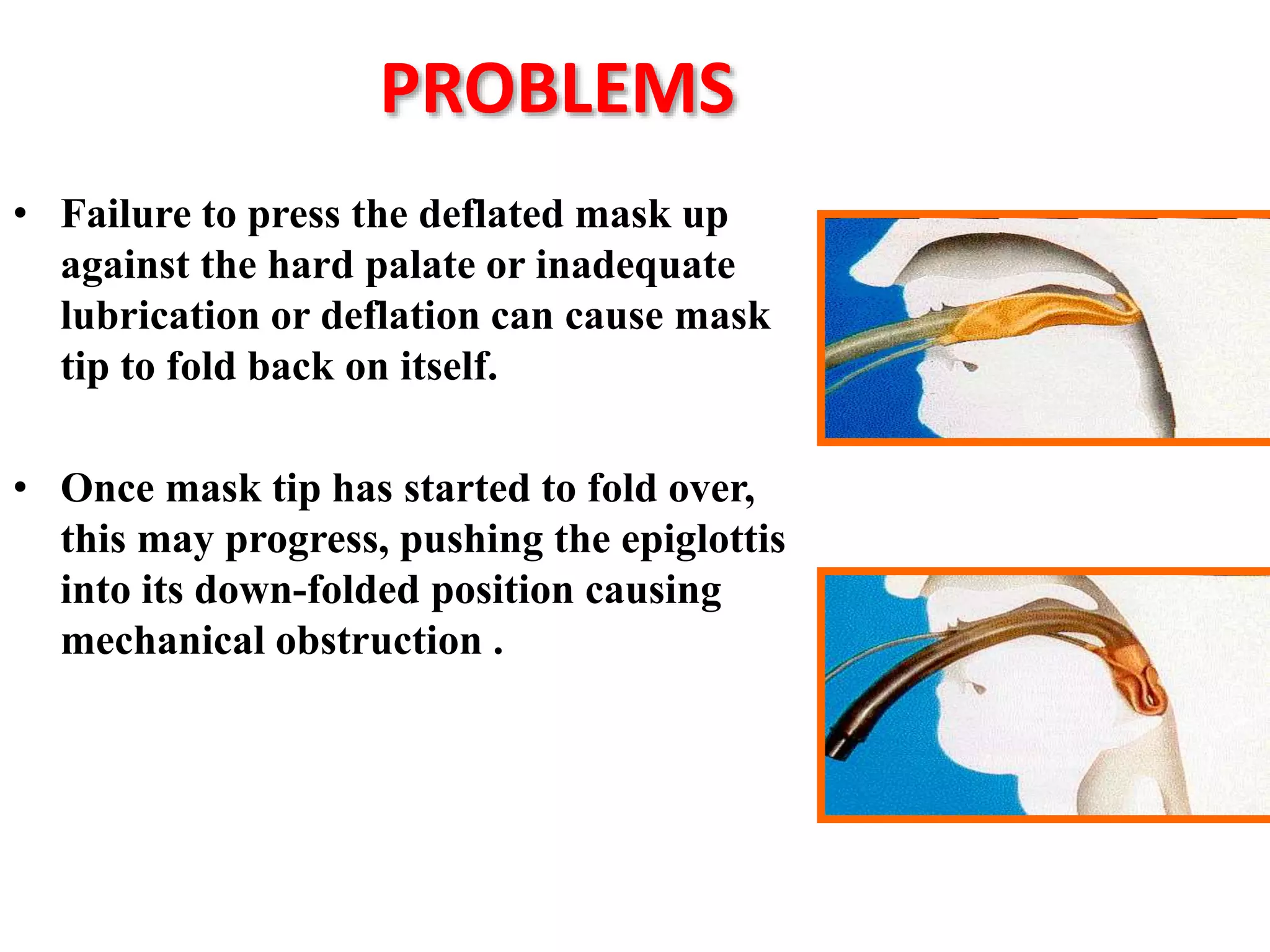 supraglottic airway devices | PPTX