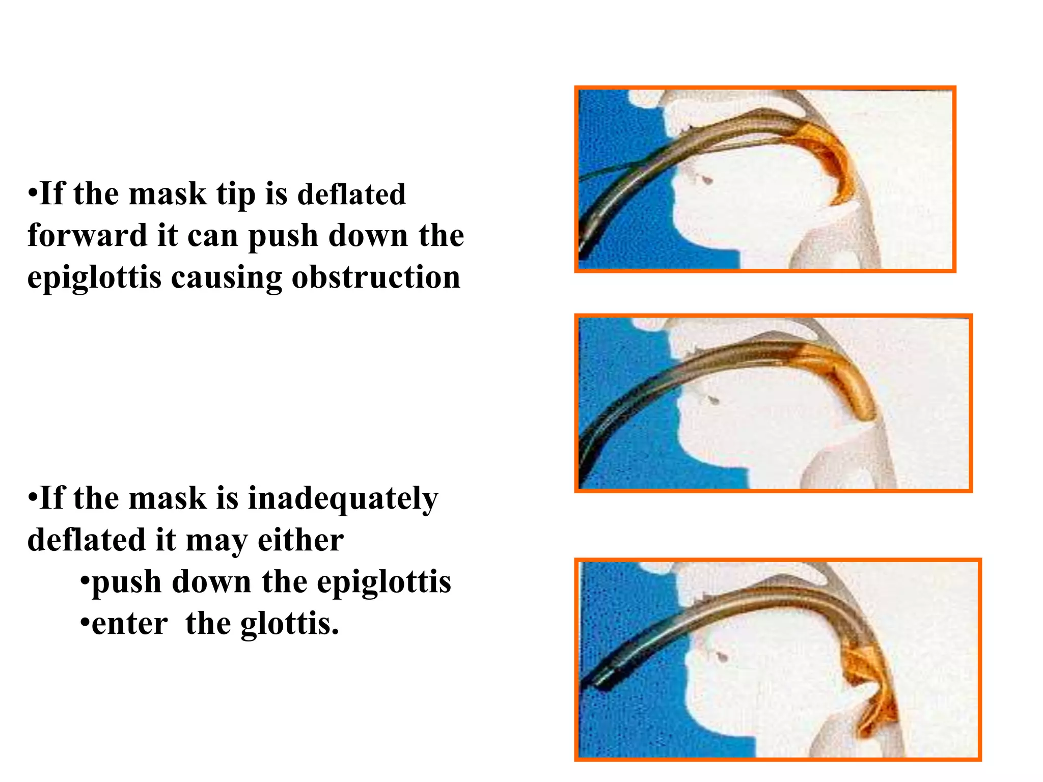 supraglottic airway devices | PPTX