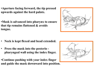supraglottic airway devices | PPTX