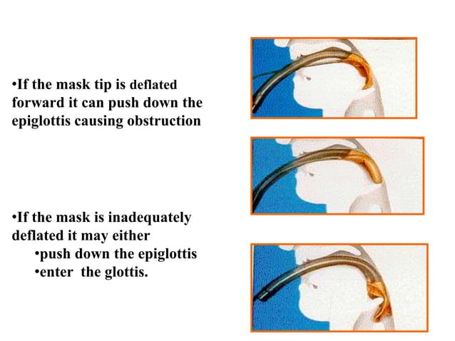 supraglottic airway devices | PPTX